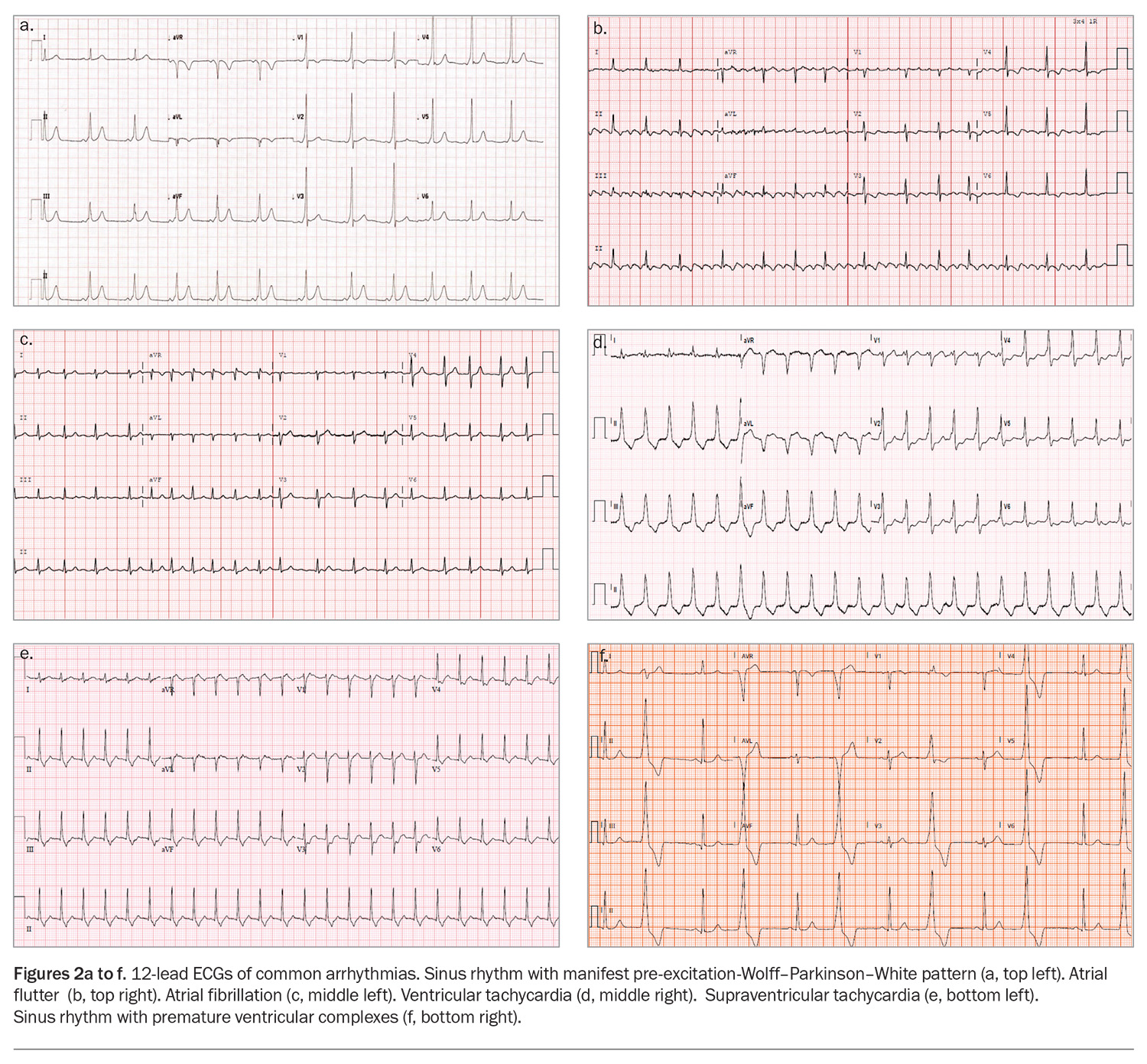 Cardiac tachyarrhythmias: a primary care approach | Medicine Today